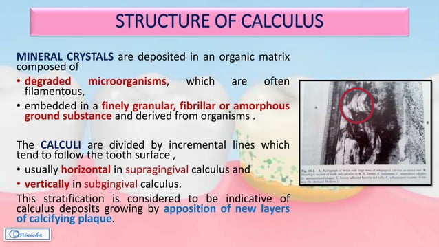 Dental calculus | PPTX | Dental Health | Diseases and Conditions