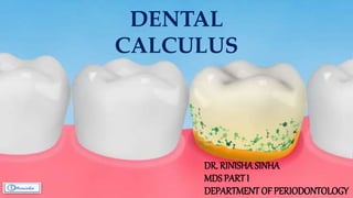 Severe Dental Calculus