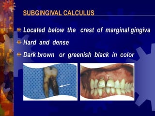 DENTAL CALCULUS.ppt