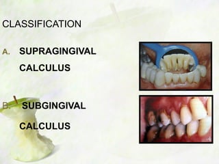Dental Calculus - Formation, Pathogenesis and Removal | PPTX