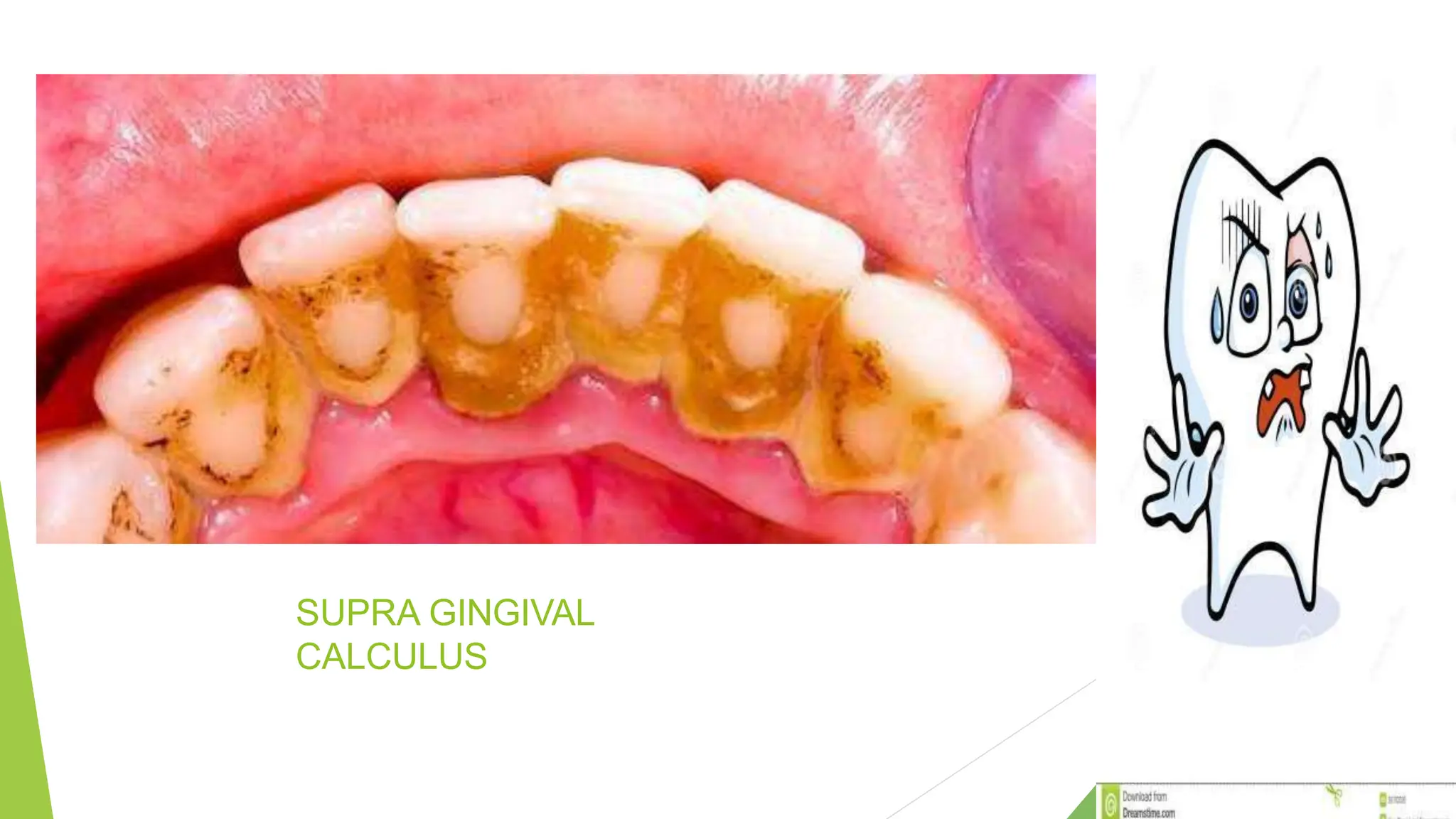 dentalcalculus_171228133124_converted (1).pptx