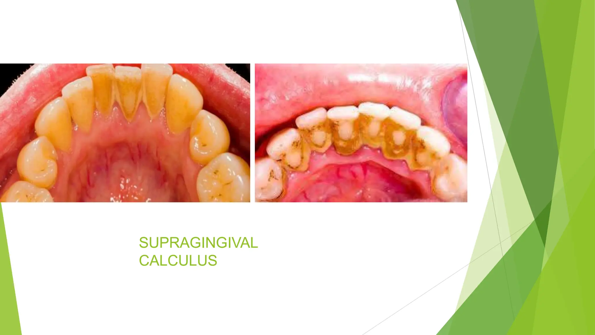 dentalcalculus_171228133124_converted (1).pptx