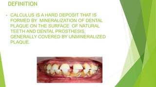 dentalcalculus_171228133124_converted (1).pptx