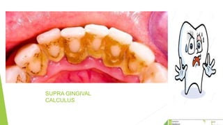 dentalcalculus_171228133124_converted (1).pptx