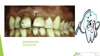 dentalcalculus_171228133124_converted (1).pptx