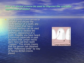 Dental caps | PPT