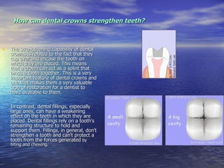 Dental caps | PPT
