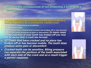 Dental caps | PPT