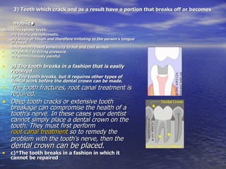 Dental caps | PPT