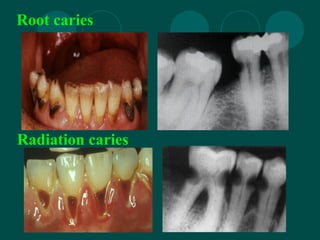Radiation Caries