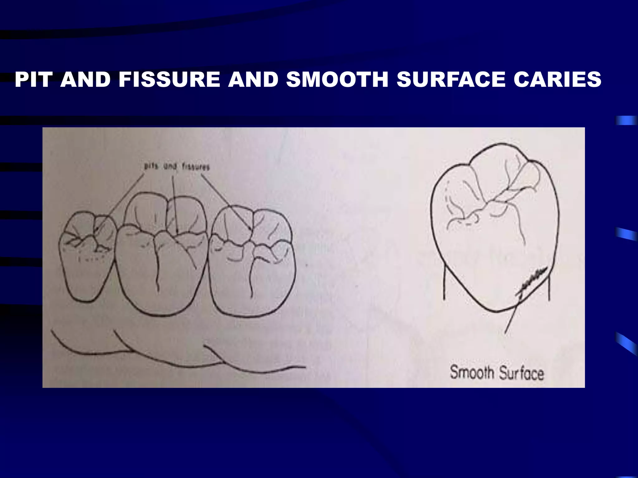 Dental caries | PPTX