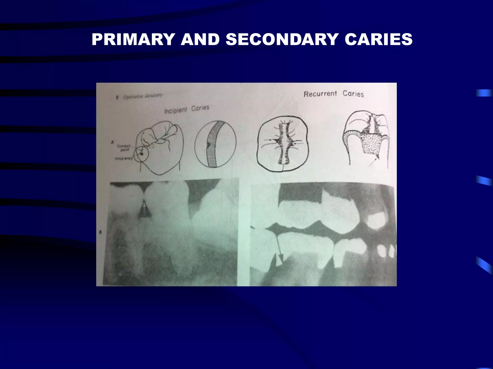 Dental caries | PPTX