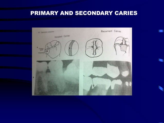 Dental caries | PPTX | Dental Health | Diseases and Conditions