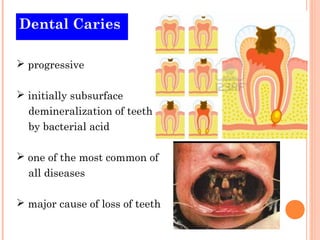 Dental Caries Progression