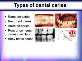 Dental caries | PPT