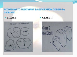 Dental caries | PPTX
