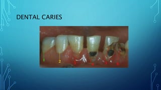 Dental caries | PPTX