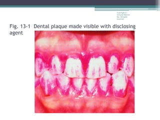 Dental caries | PPTX