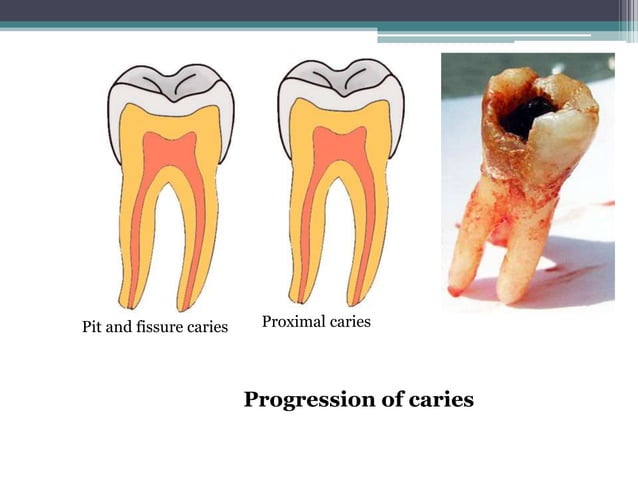 Dental caries