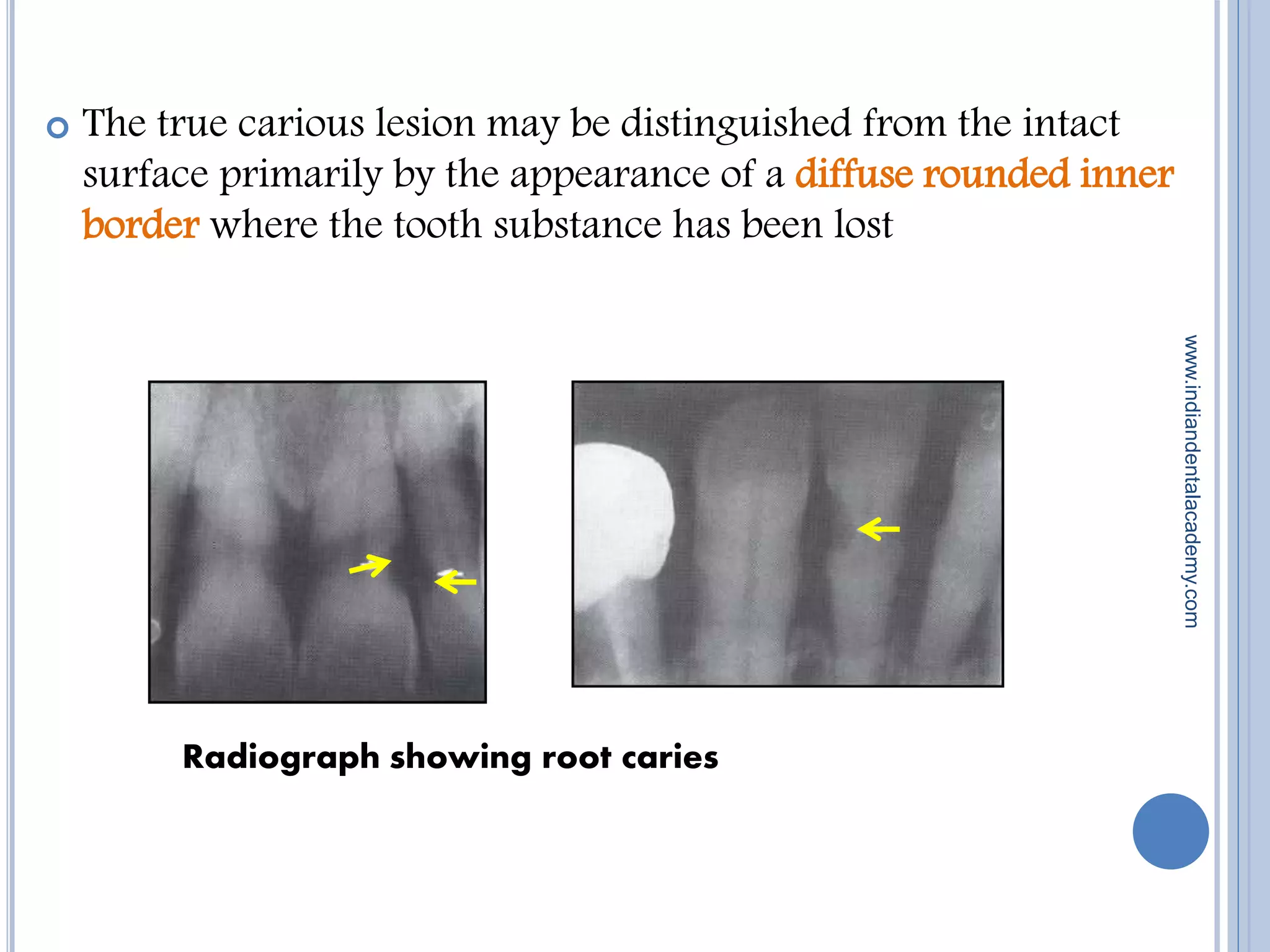 Dental caries / dental implant courses | PPTX