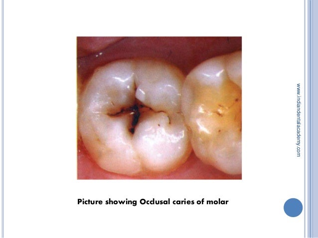 Dental caries / dental implant courses