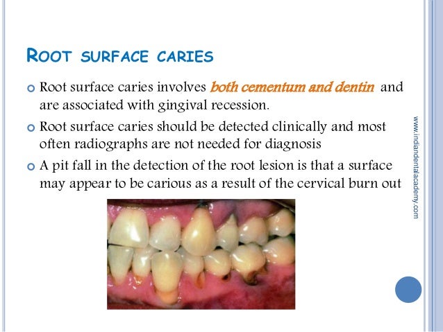 Dental caries / dental implant courses