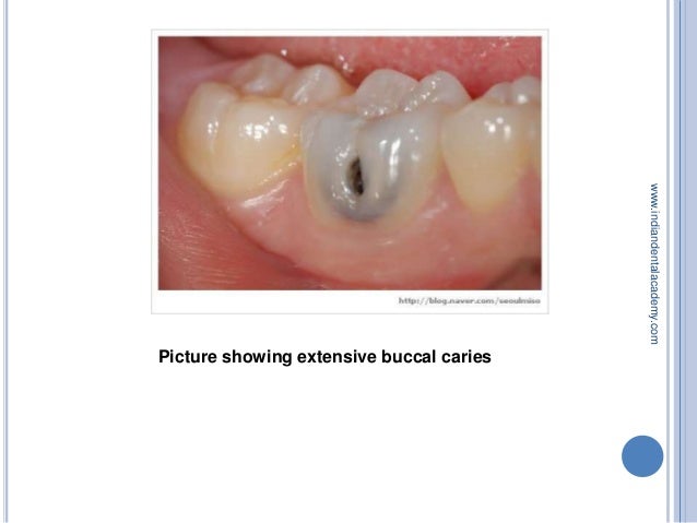 Dental caries / dental implant courses