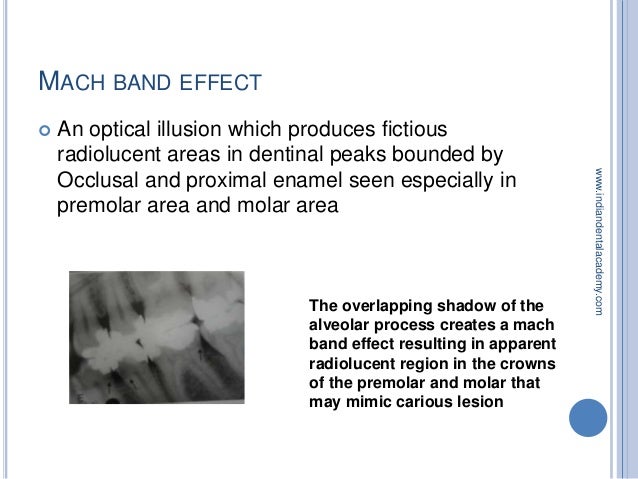 Dental caries / dental implant courses