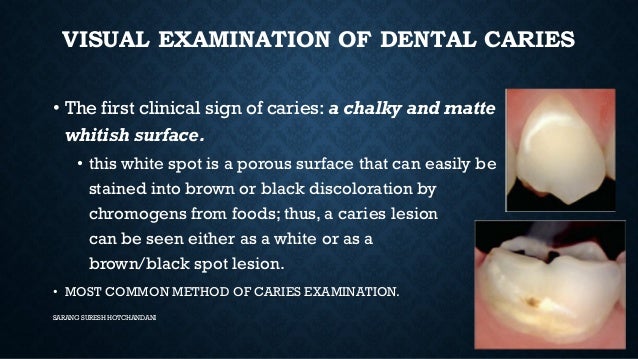 Dental Caries