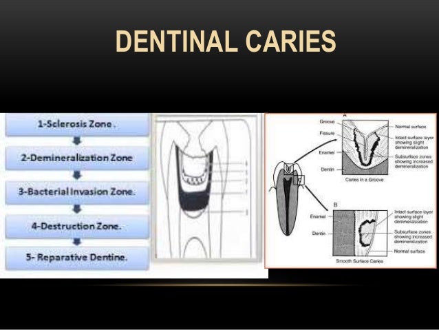 Dental caries