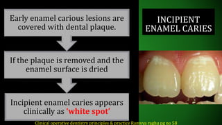 Dental caries | PPTX