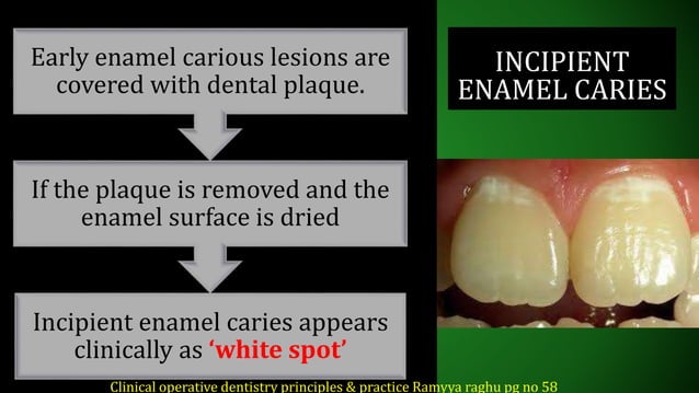 Dental caries | PPTX | Oral care | Personal Care