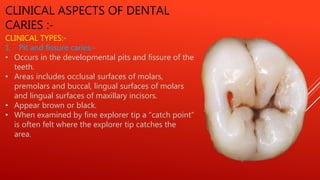 Dental caries | PPTX