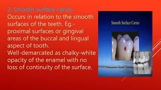 Dental caries | PPTX