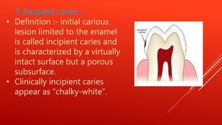Dental caries | PPTX