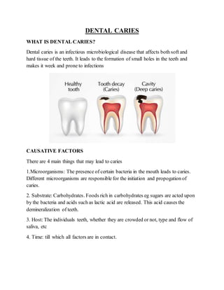 Dental caries | PDF