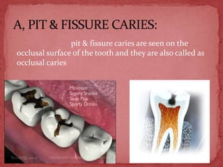 Dental caries | PPTX