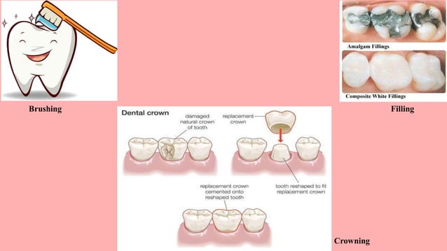 Dental caries | PPT