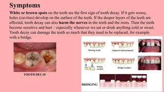 Dental caries | PDF