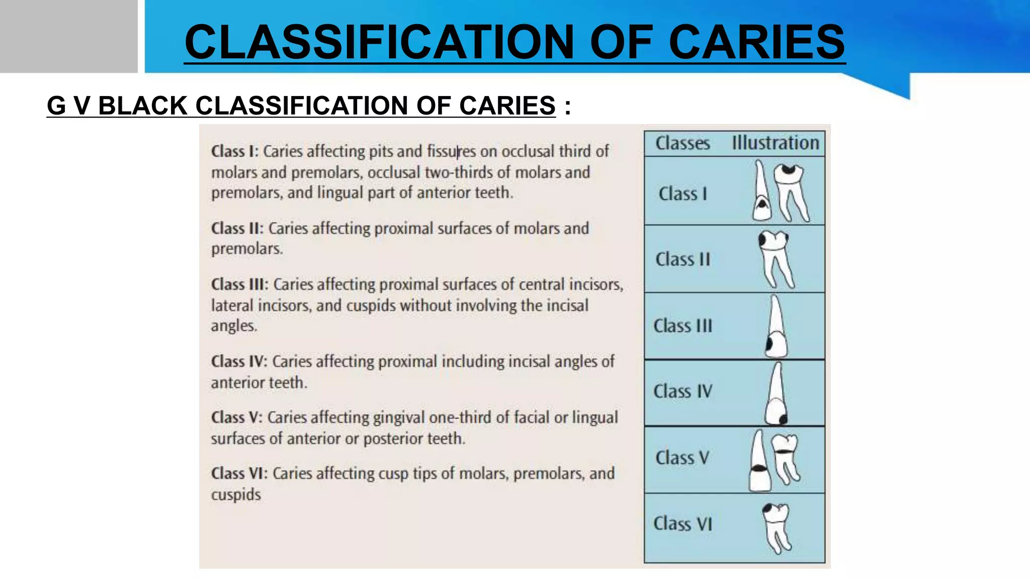 Dental Caries | PPTX