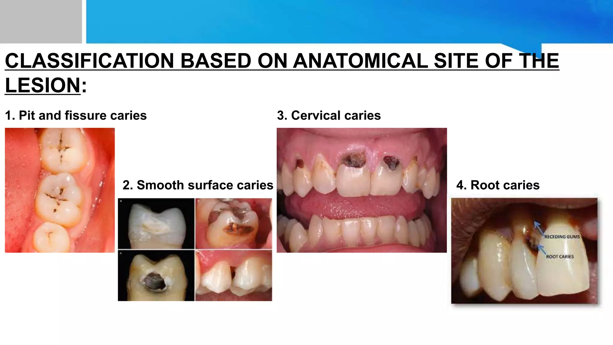 Dental Caries | PPTX