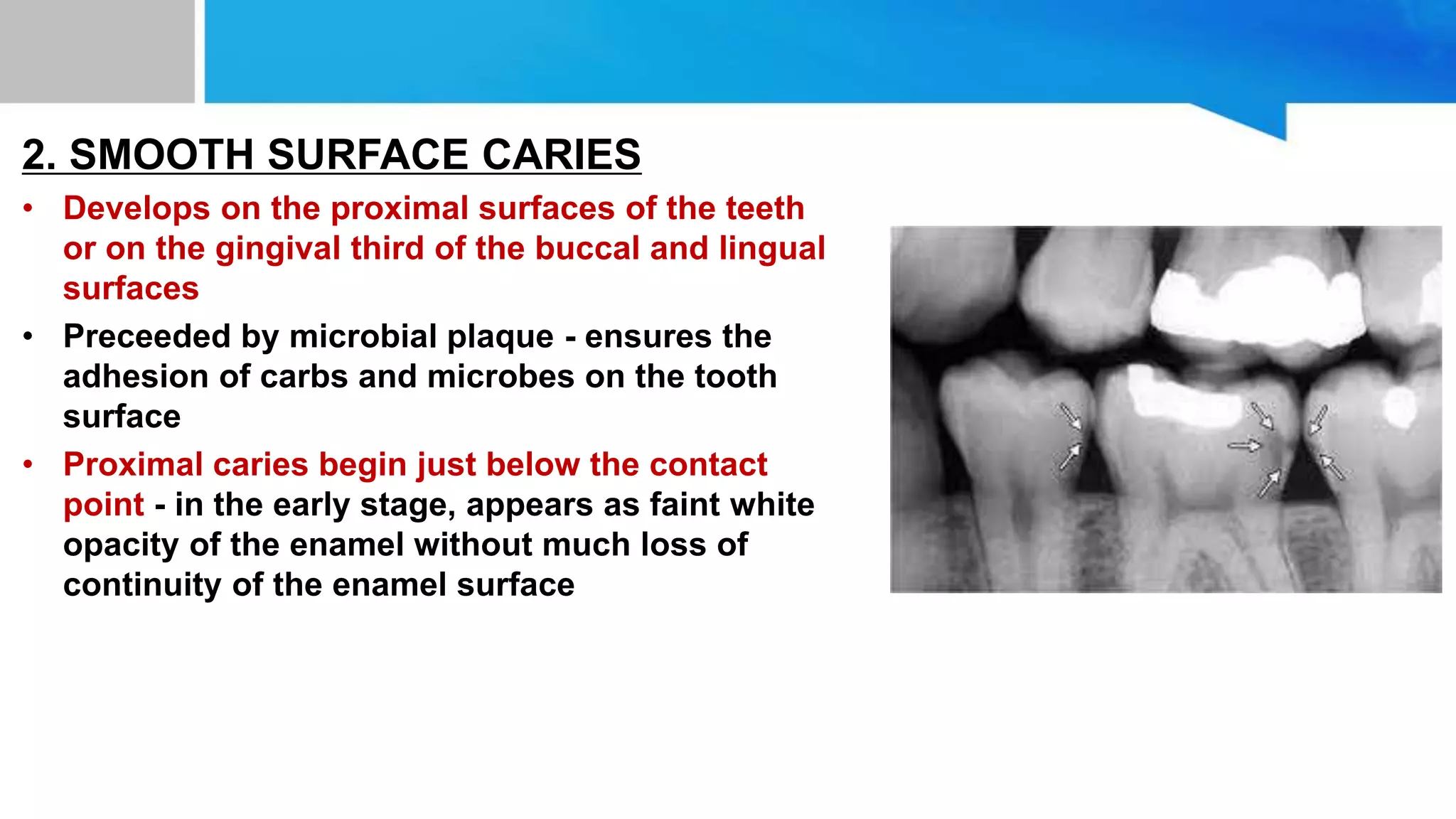 Dental Caries | PPTX