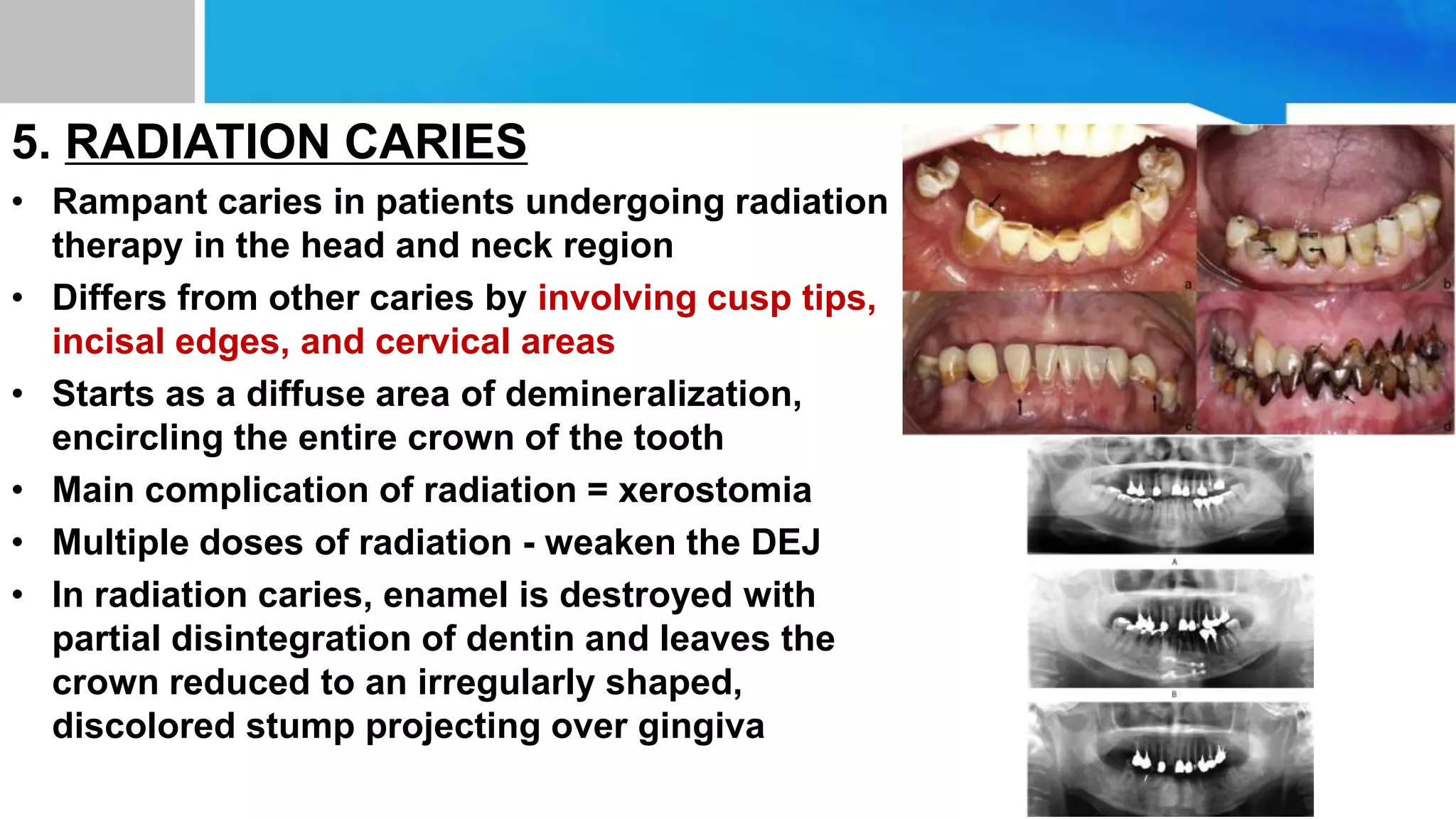 Dental Caries | PPTX