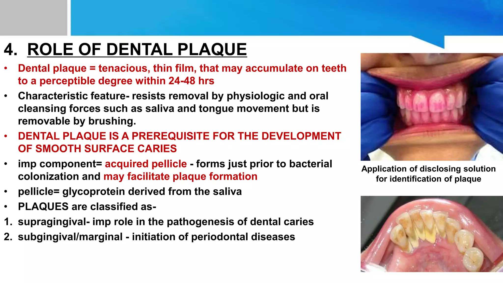 Dental Caries | PPTX