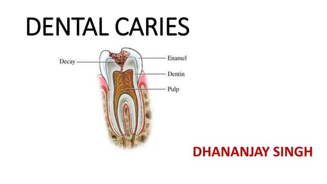 Dental Caries Causes and Treatment | PPT