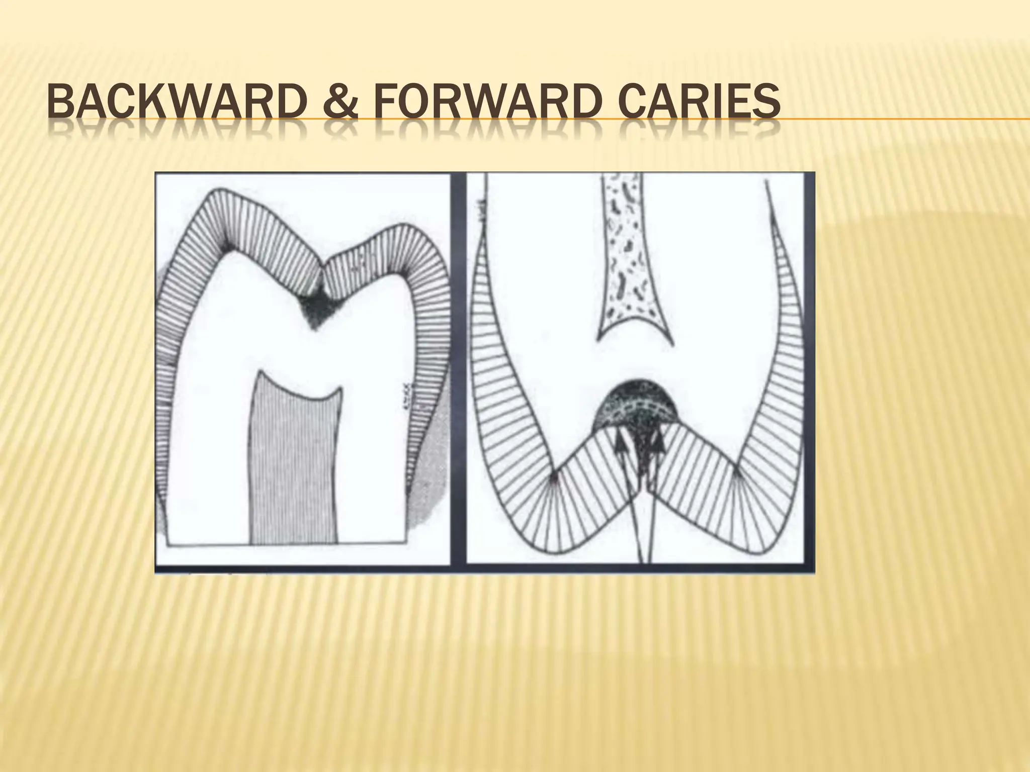 DENTAL CARIES classification, types, treatment and prognosis | PPT