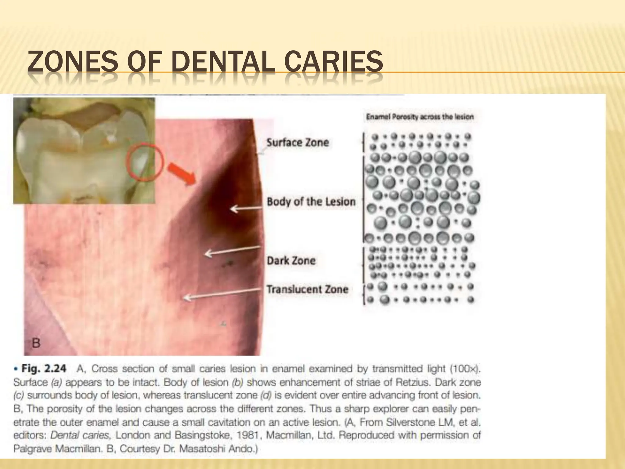 DENTAL CARIES classification, types, treatment and prognosis | PPT