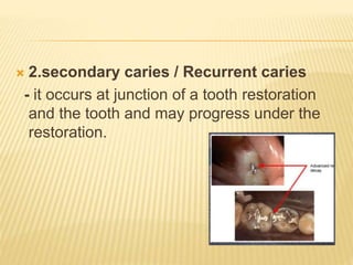 DENTAL CARIES classification, types, treatment and prognosis | PPT