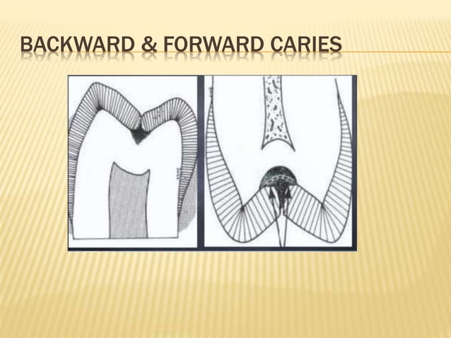 DENTAL CARIES classification, types, treatment and prognosis | PPT