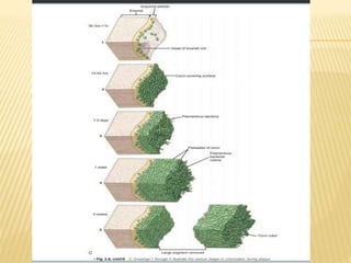 DENTAL CARIES classification, types, treatment and prognosis | PPT